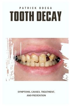 Libro Tooth Decay: Symptoms, Causes, Treatment, and Prevention (en ...
