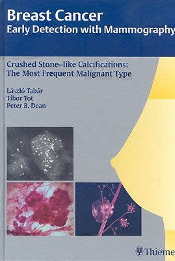 Libro Breast Cancer: Early Detection with Mammography: Crushed Stone ...
